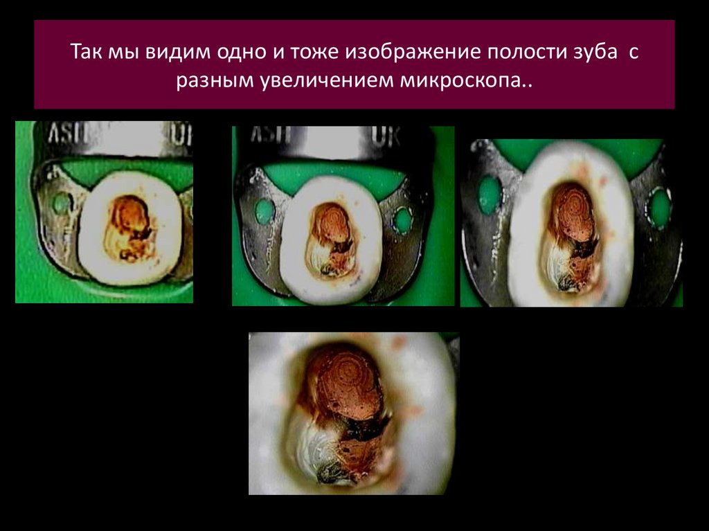 Пломбирование корневых каналов зуба - презентация онлайн