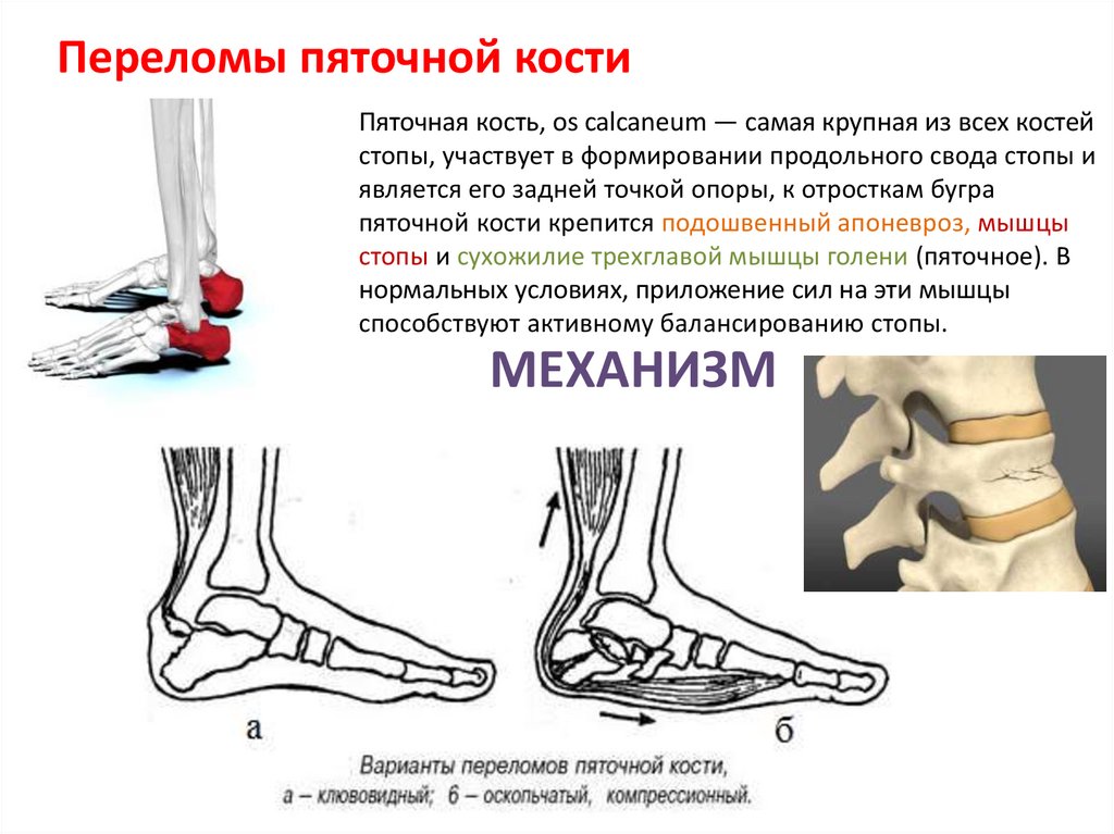 Переломы стопы - презентация онлайн