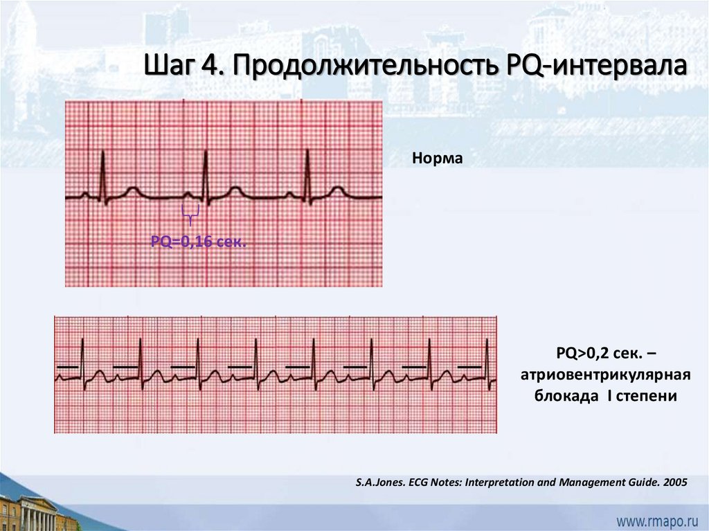 Нарушения сердечного ритма и проводимости: клиника, диагностика ...