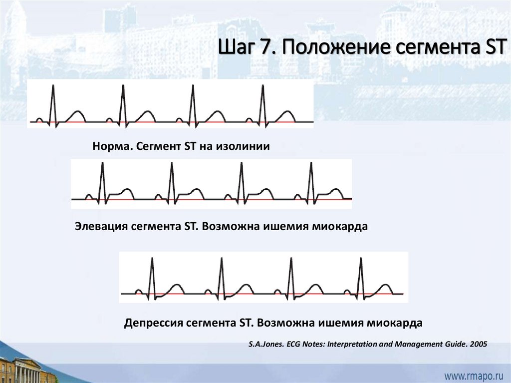 Нарушения сердечного ритма и проводимости: клиника, диагностика ...