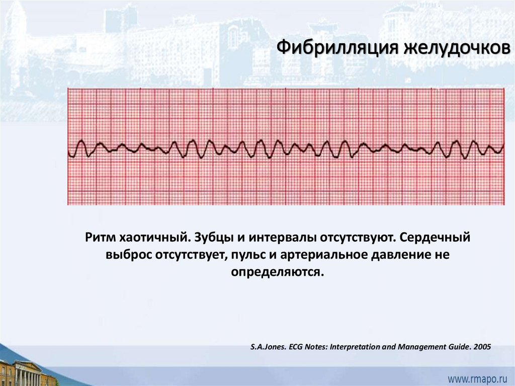 Нарушения сердечного ритма и проводимости: клиника, диагностика ...