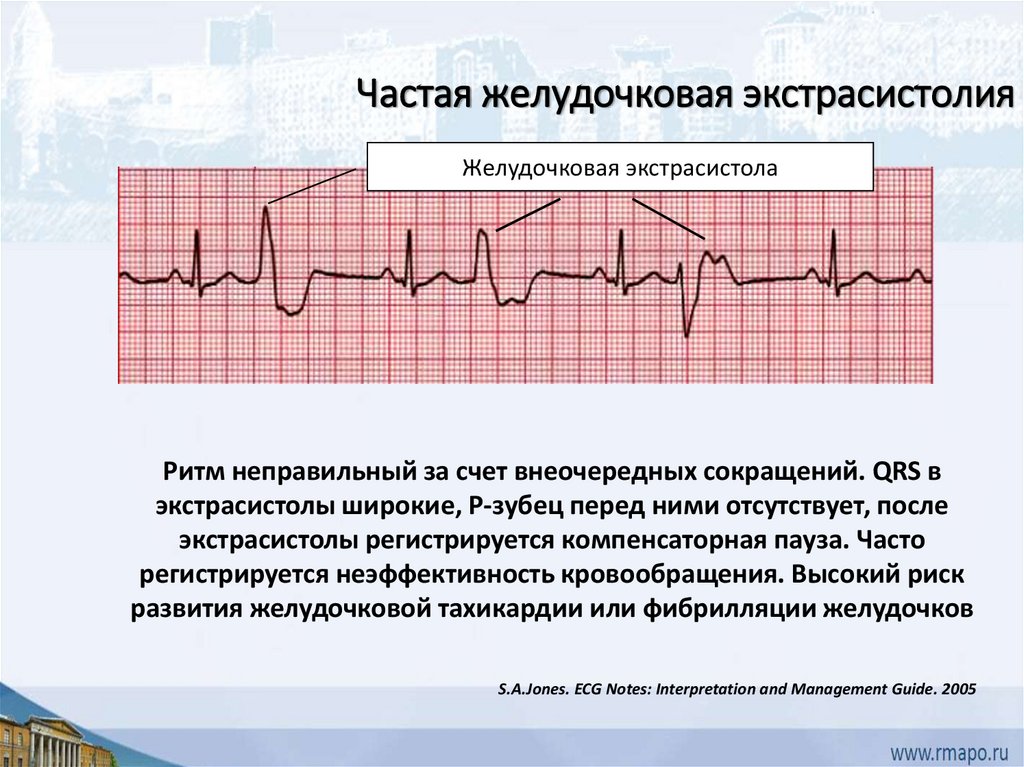 Нарушения сердечного ритма и проводимости: клиника, диагностика ...