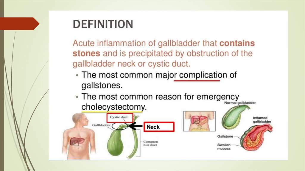 Carcinoma of gallbladder and cholicystitis - презентация онлайн